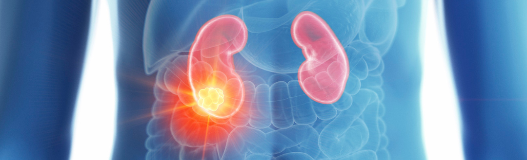 Kidney Cancer – ValAsta Jewish